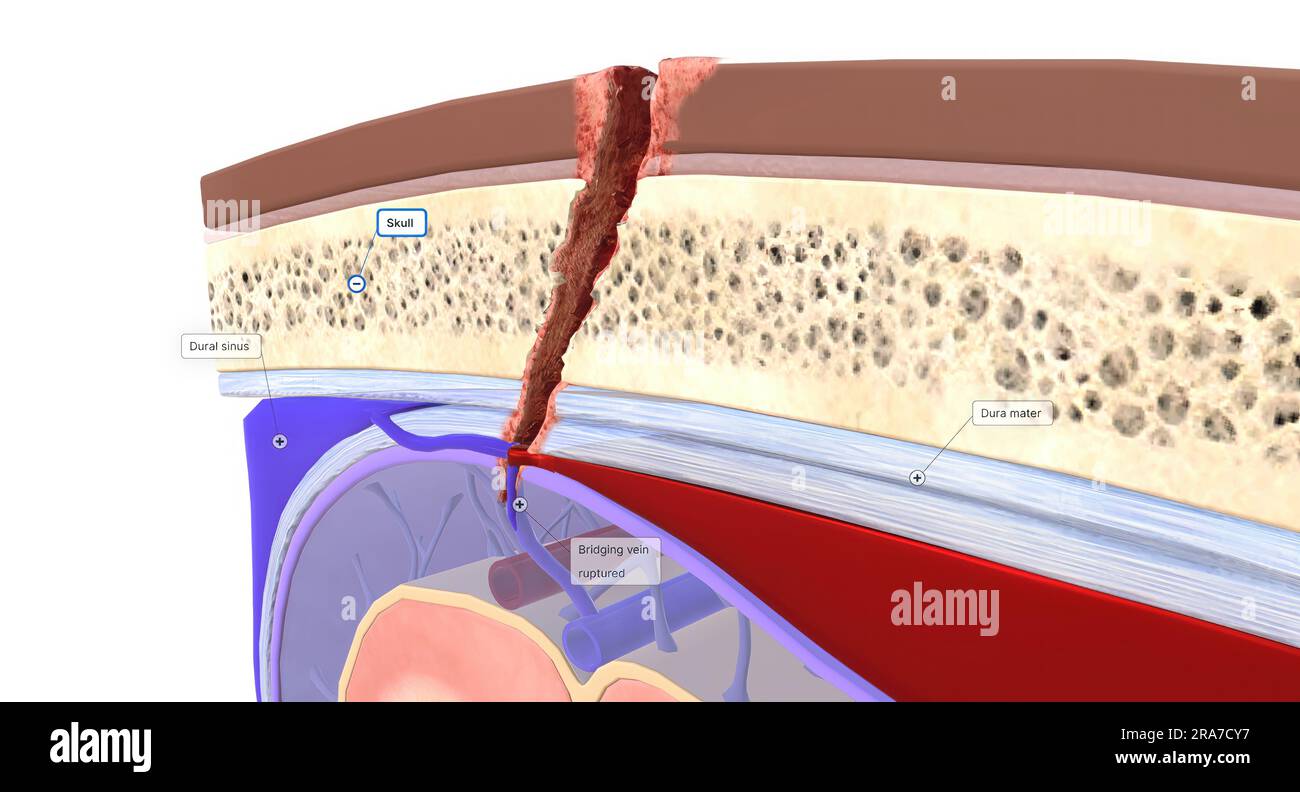Renal aneurysms hi-res stock photography and images - Alamy