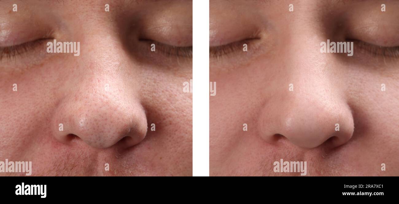 Photos of man before and after acne treatment, closeup. Collage showing ...
