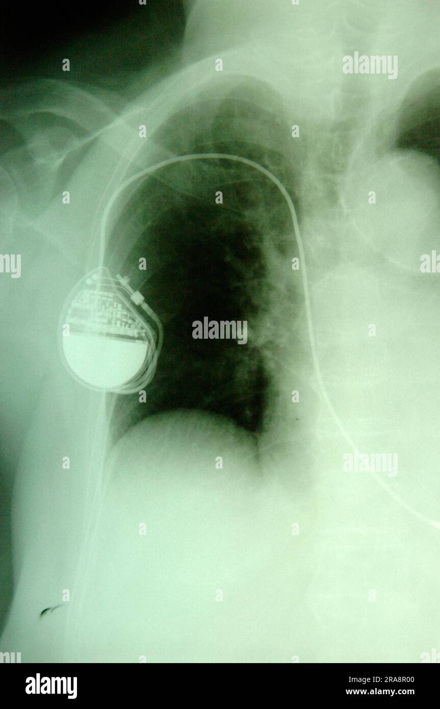 X-ray image of pacemaker, X-ray image, X-ray diagnostics, X-ray image ...