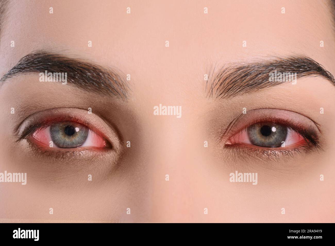 Woman with red eyes suffering from conjunctivitis, closeup Stock Photo ...