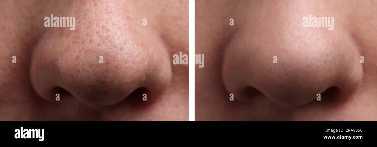 Blackheads Removal Before And After