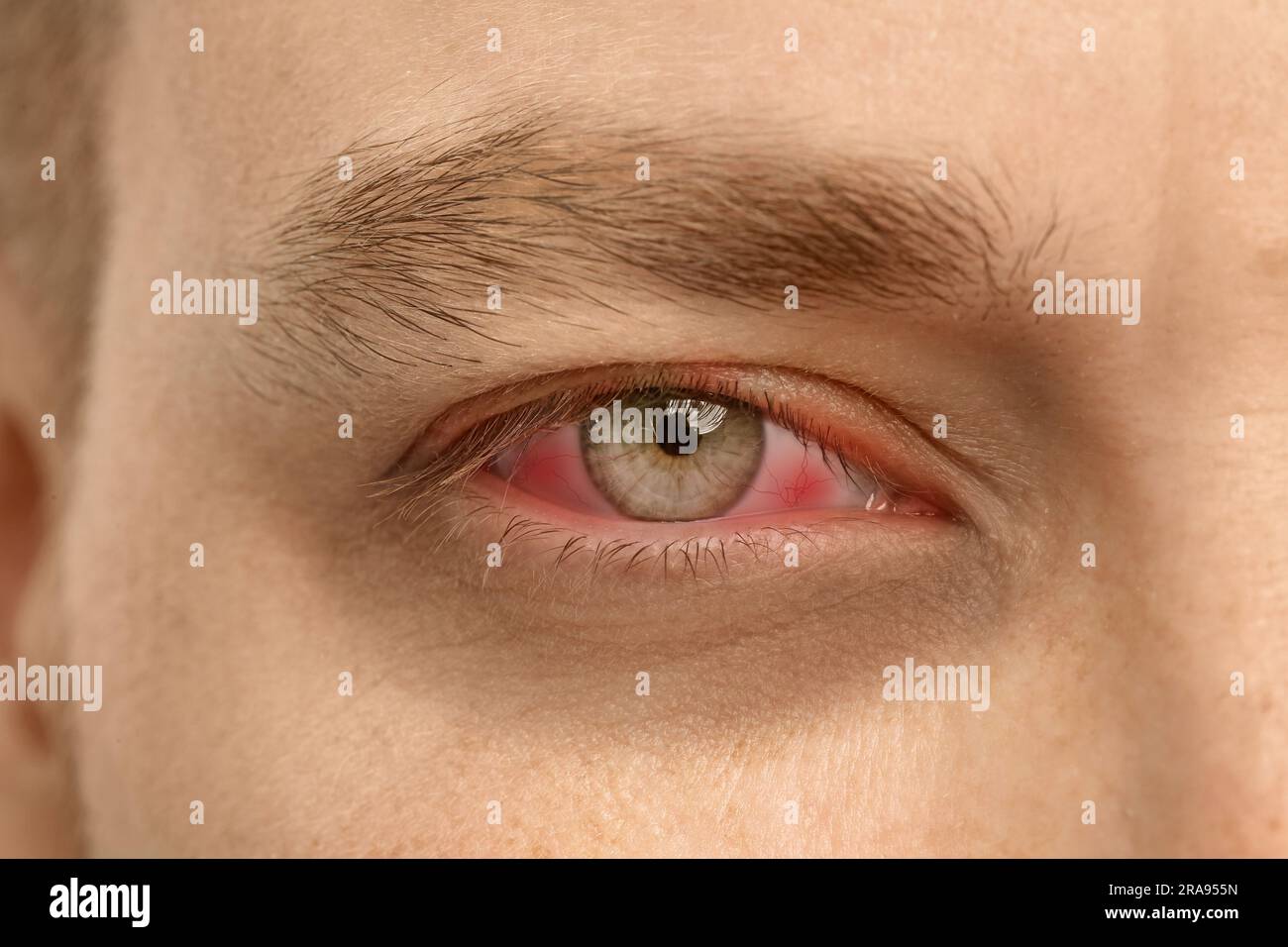 Man suffering from conjunctivitis, closeup of red eye Stock Photo - Alamy