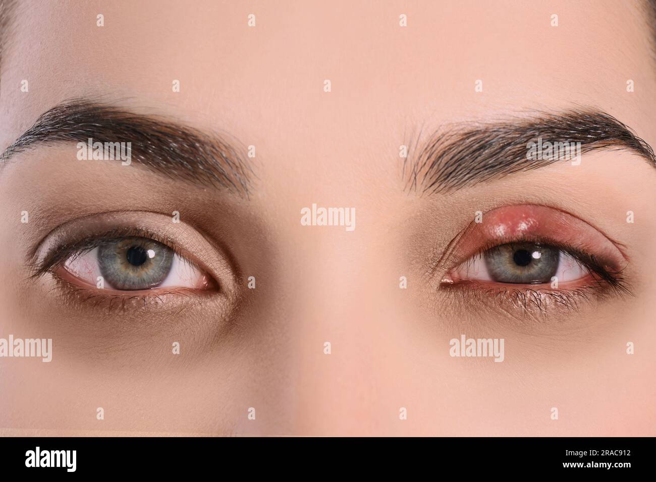 Conjunctival edema hi-res stock photography and images - Alamy