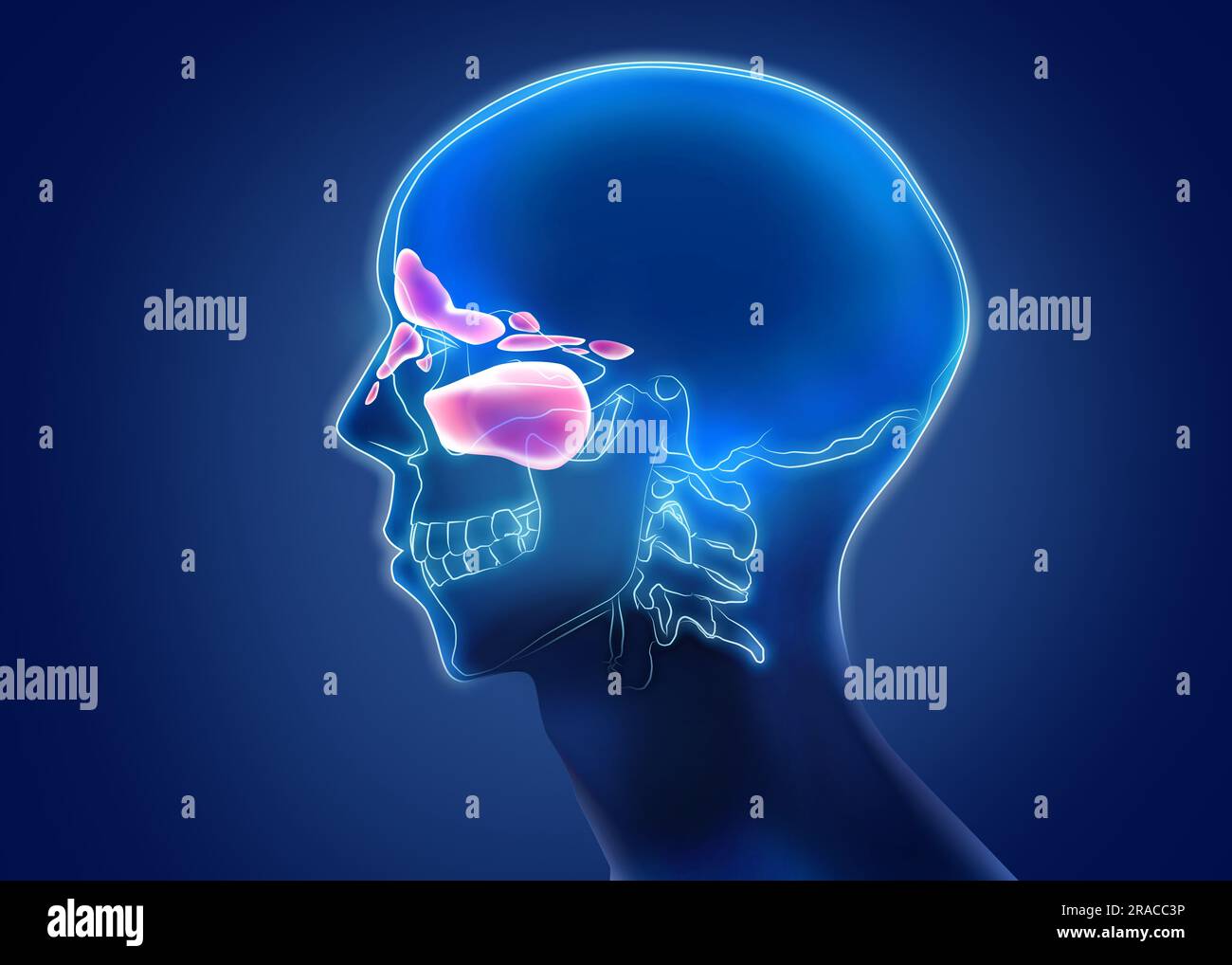 X-ray picture of man showing progressing sinusitis in nasal cavities on ...