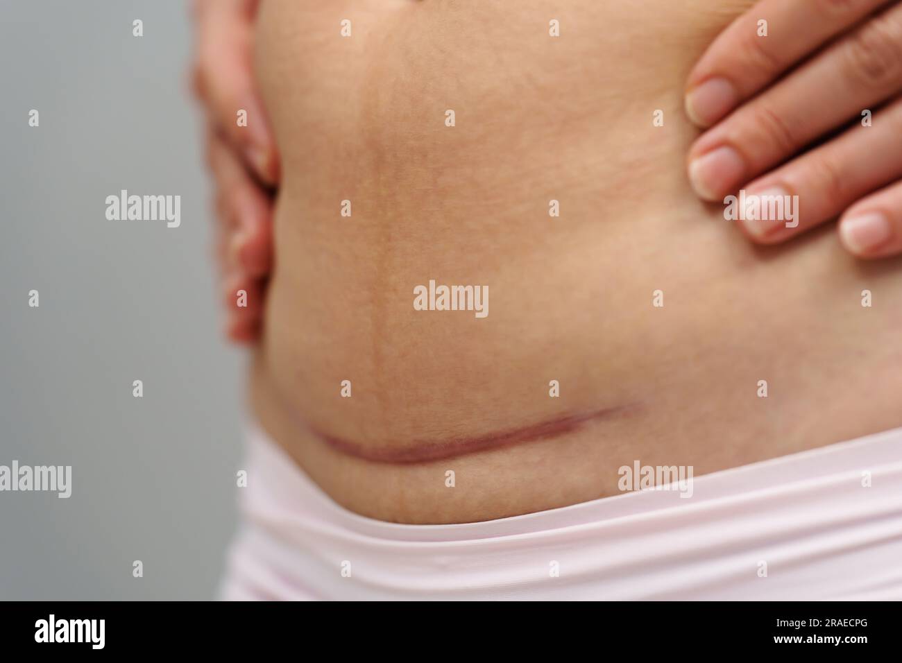 close up belly of woman with a c-section scar of caesarean Stock Photo - Alamy
