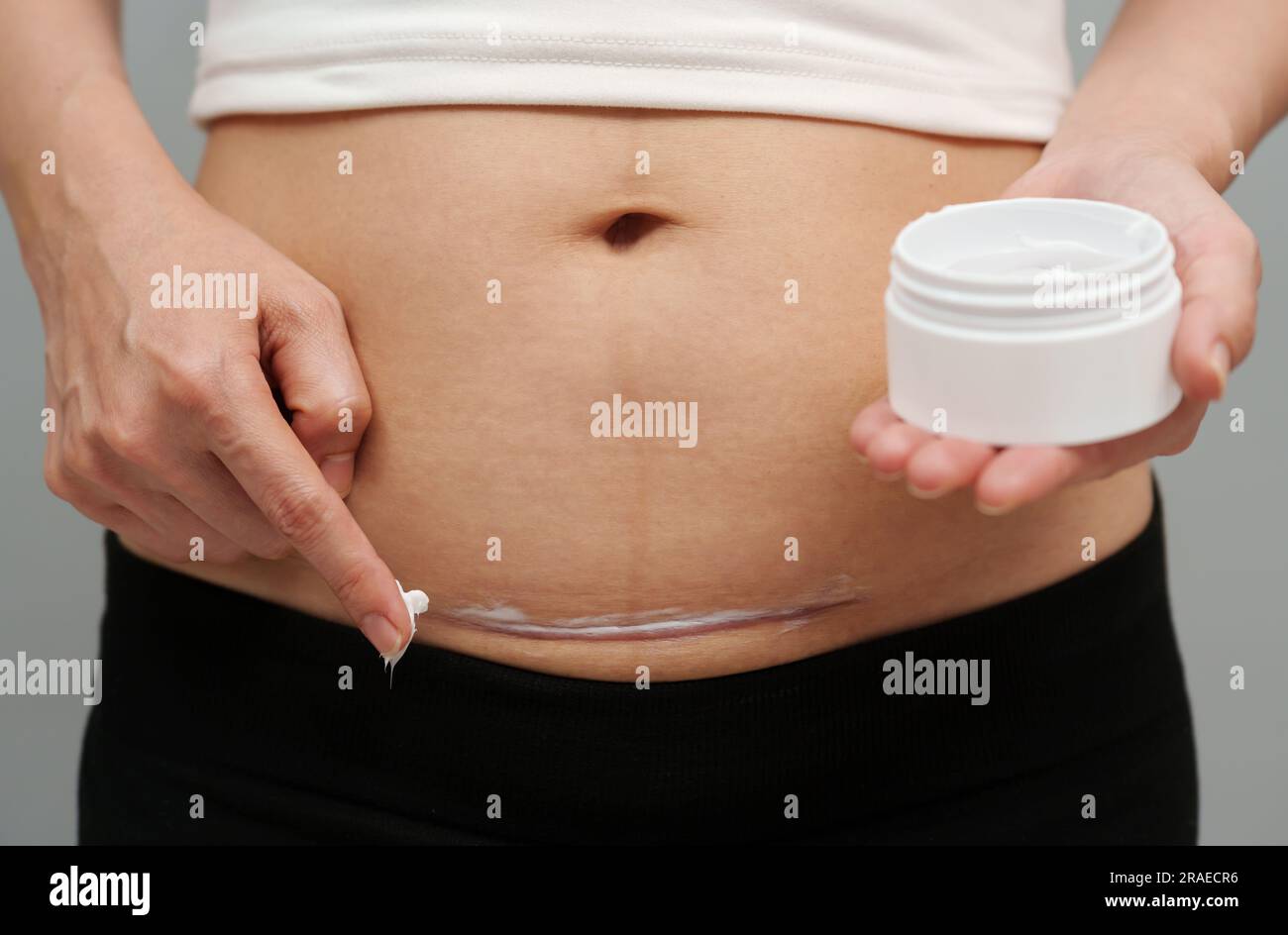 Woman Putting Healing Cream In The C Section Scar Of Cesarean Stock