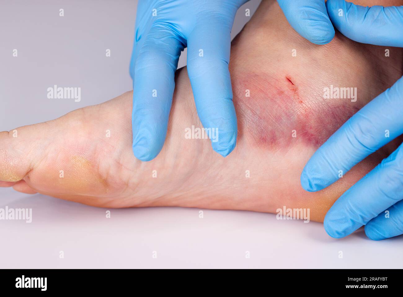Doctor is examining an injured foot with bruise and scratch Stock Photo ...
