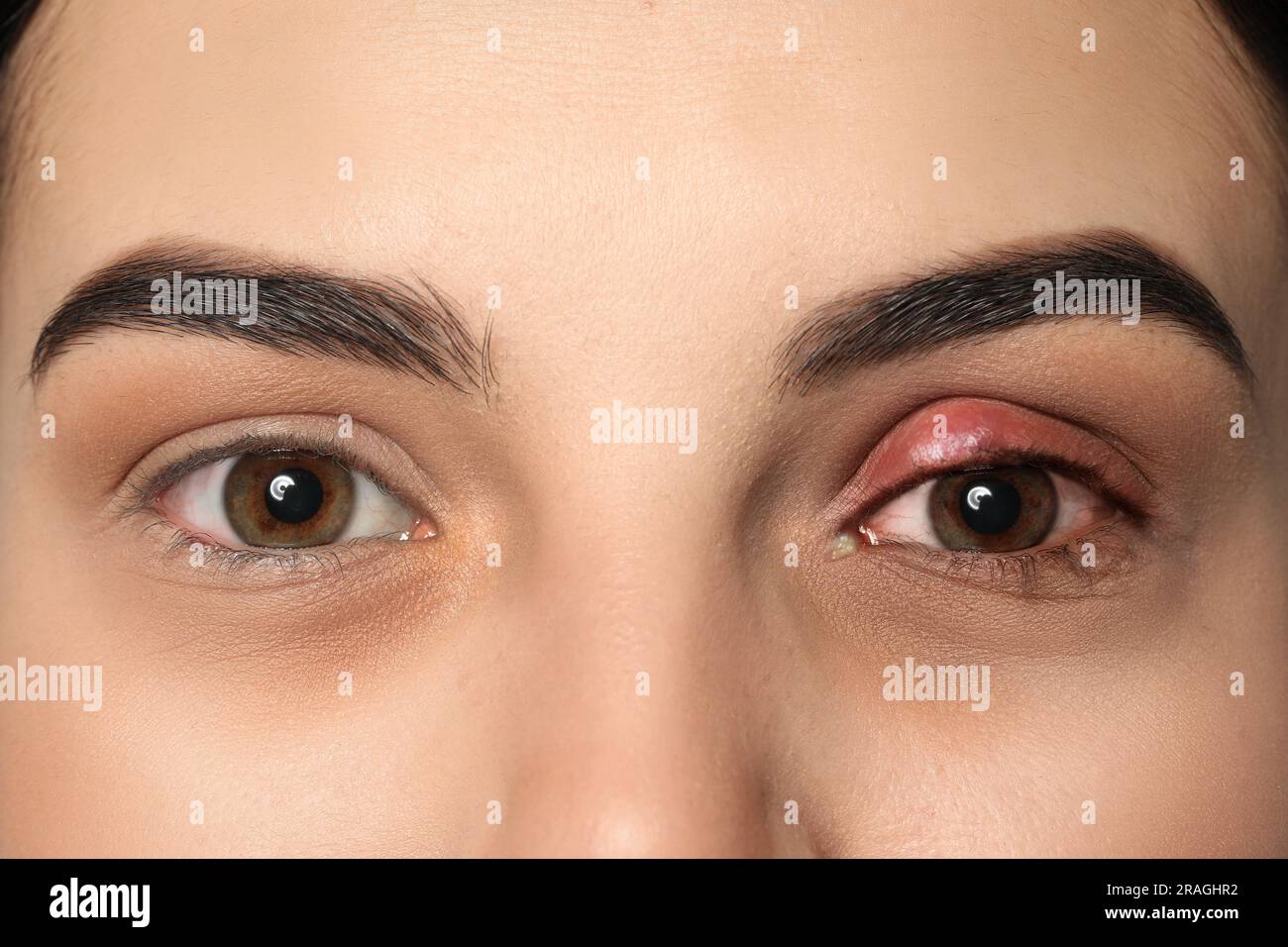 Conjunctival edema hi-res stock photography and images - Alamy