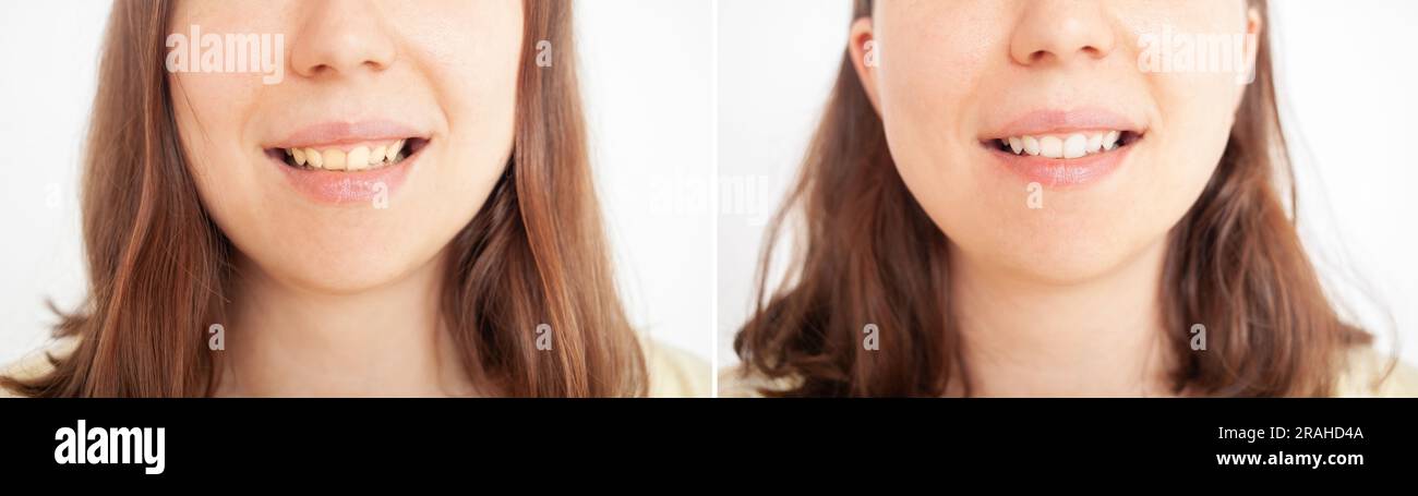 person smiles, shows teeth, yellow plaque, crooked teeth, malocclusion ...