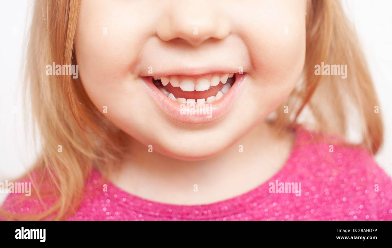Girl child smiling, white teeth after brushing and whitening, childhood ...