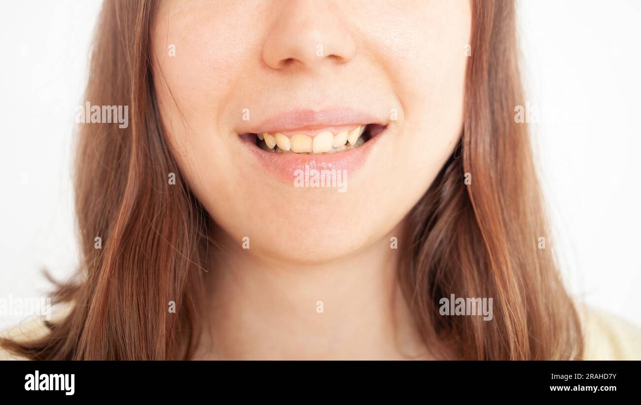 person smiles, shows teeth yellow plaque crooked teeth, malocclusion ...
