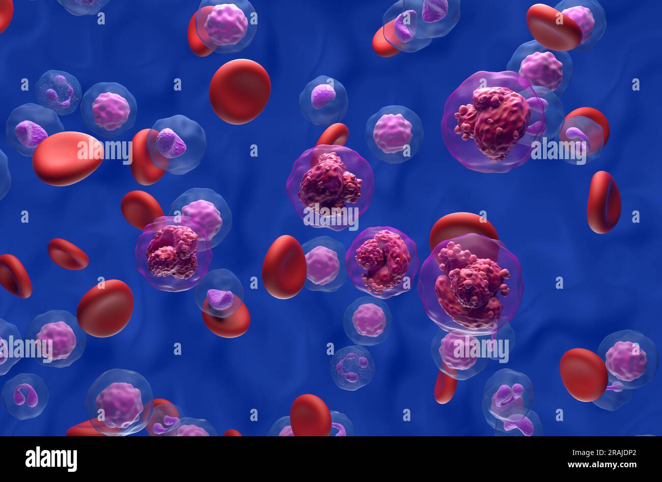 Acute lymphoblastic leukemia (ALL) cancer cells in the blood flow ...
