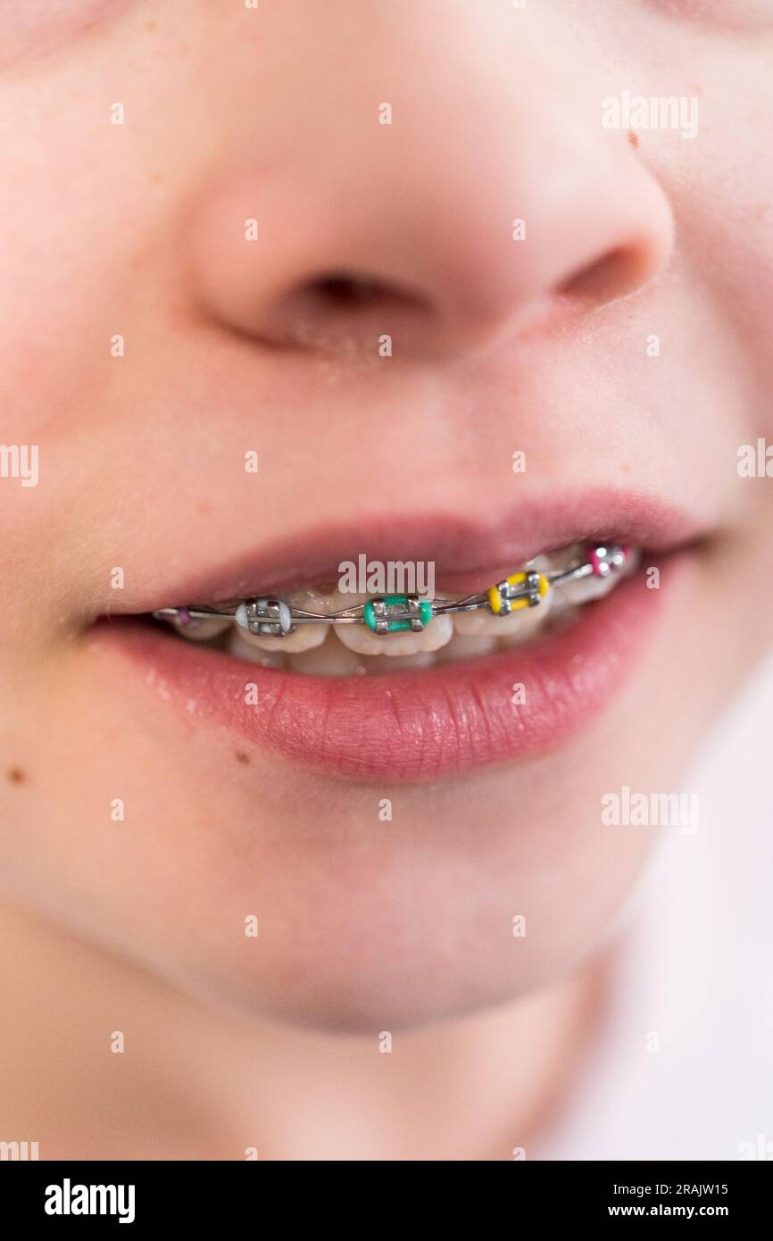 Little girl with rainbow braces Stock Photo - Alamy