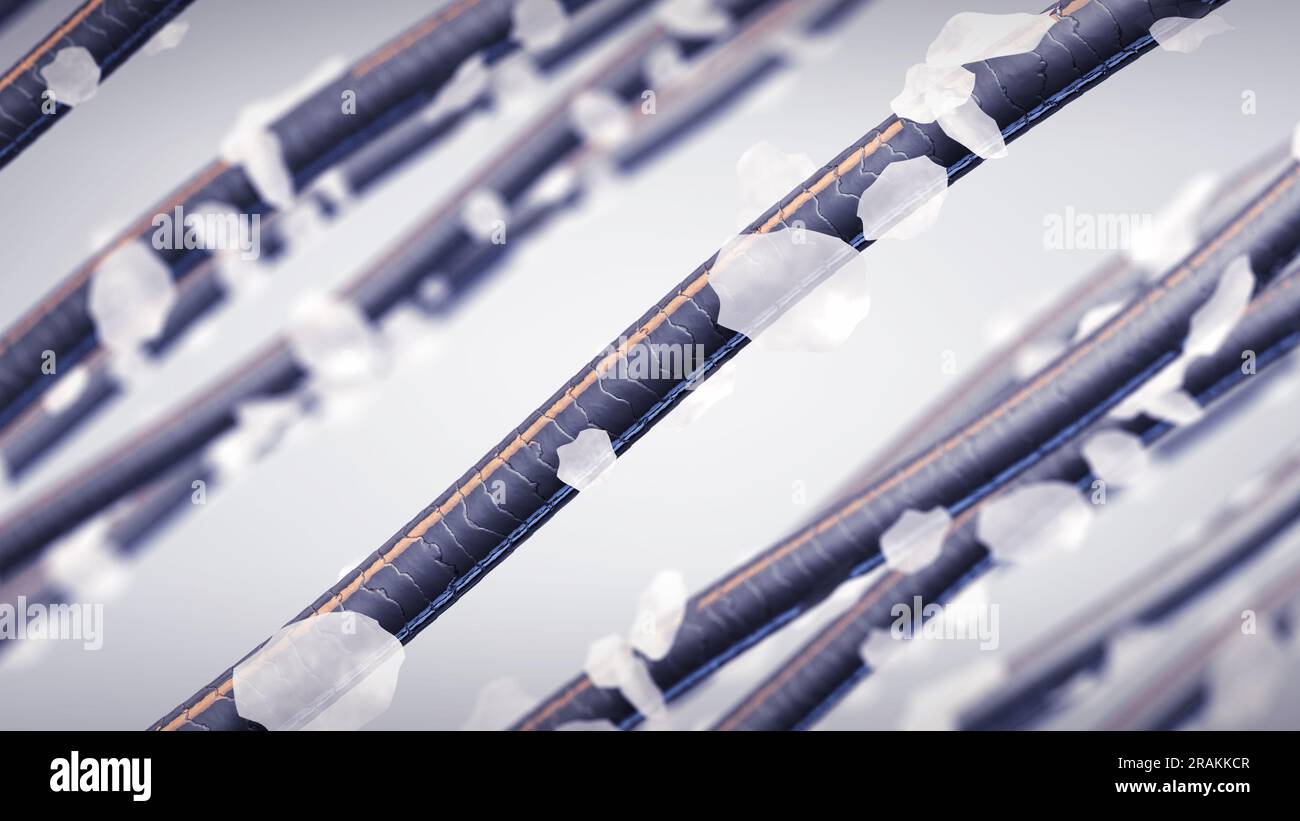 Dandruff flakes on hair strands. Dandruff (dead skin cells) prevention ...