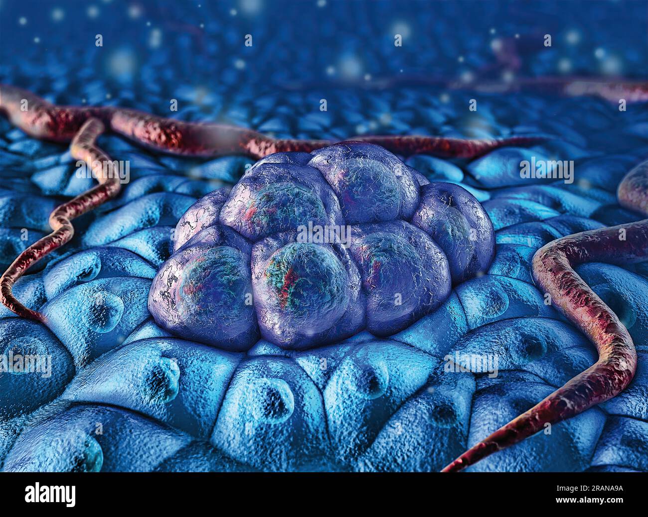 Cancerous tumour, illustration Stock Photo - Alamy