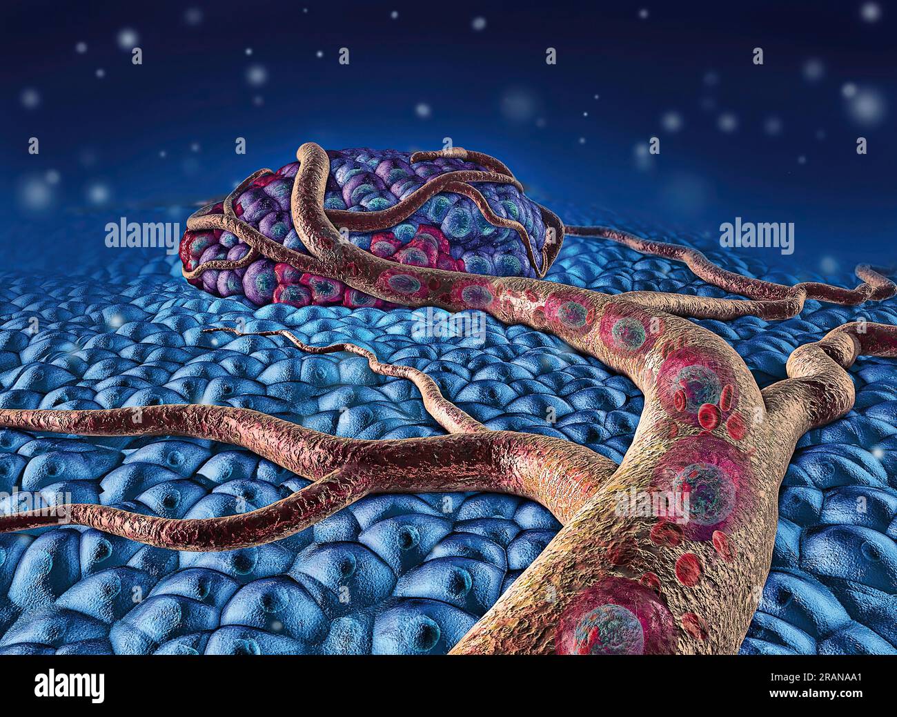 Cancer metastasis, illustration Stock Photo - Alamy