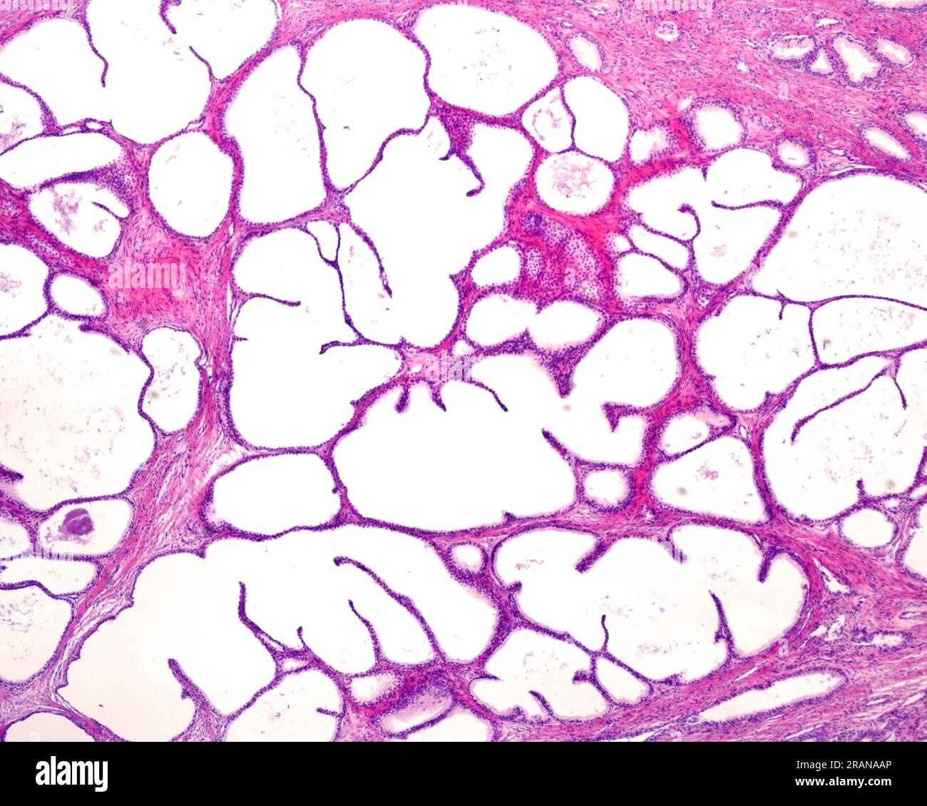 Benign prostatic hyperplasia, light micrograph Stock Photo - Alamy