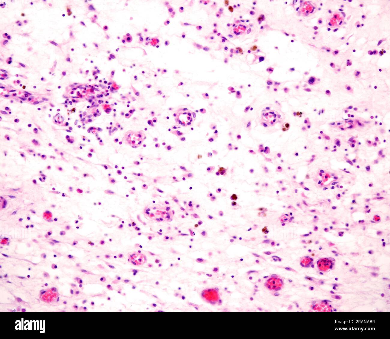 Chronic inflammation in connective tissue, light micrograph Stock Photo ...