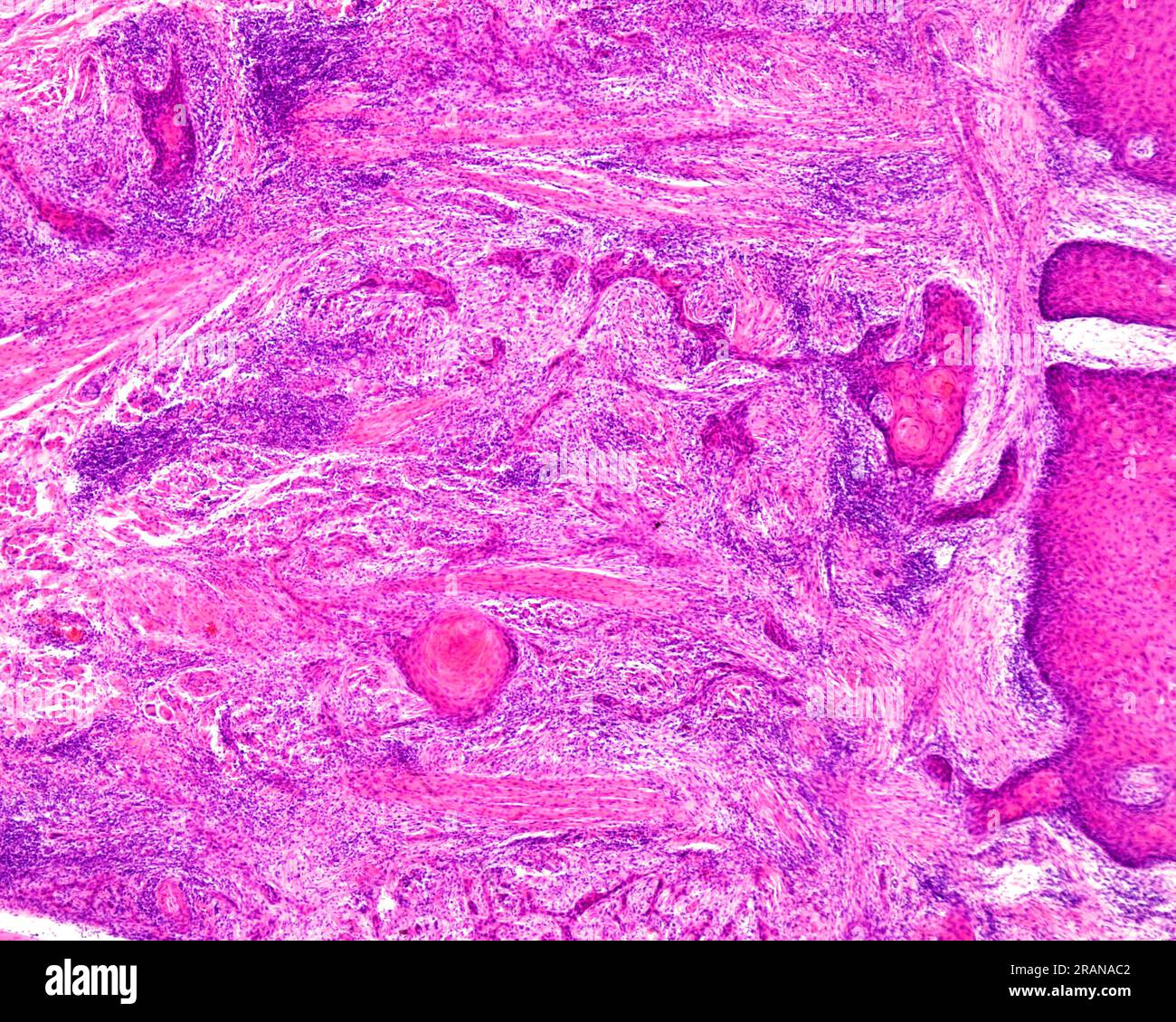 Epidermoid carcinoma of the tongue, light micrograph Stock Photo - Alamy