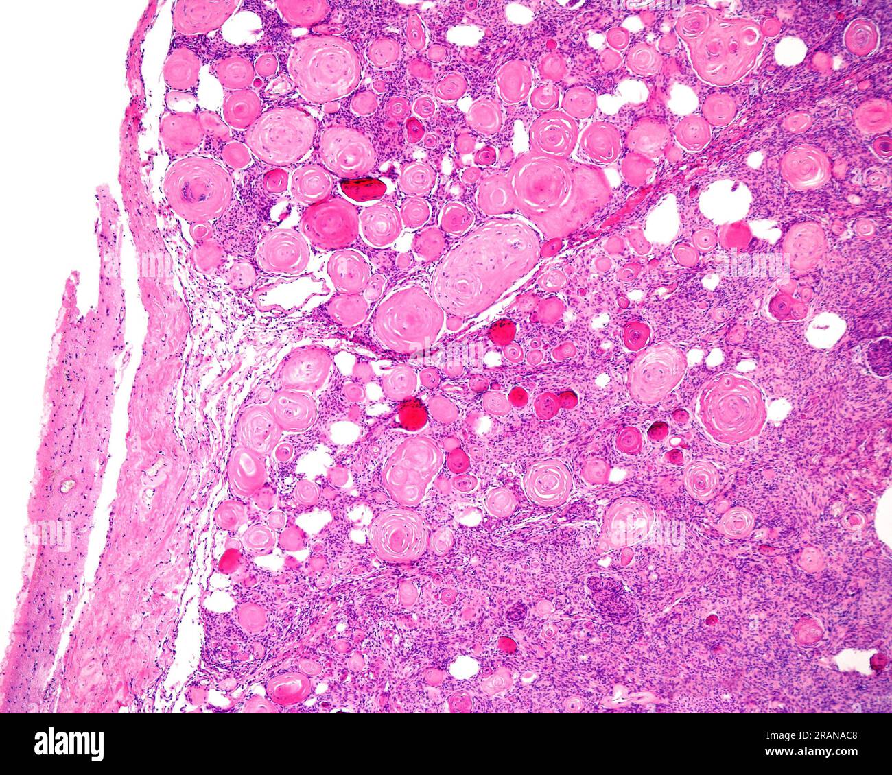 Psammoma bodies in meningioma, light micrograph Stock Photo - Alamy
