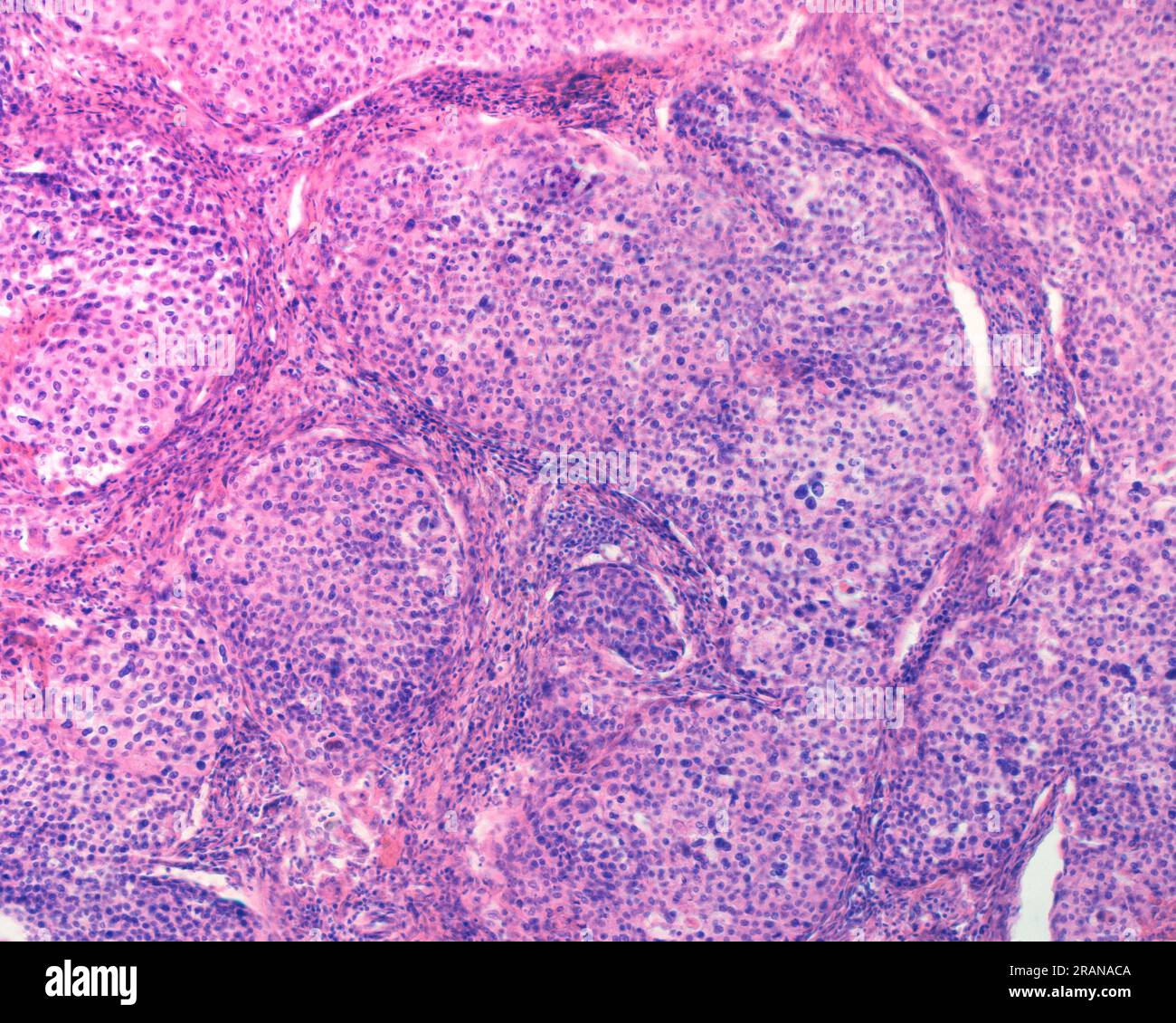 Carcinoma of the ovary, light micrograph Stock Photo - Alamy Carcinoma of the ovary, light micrograph Stock Photo - Alamy