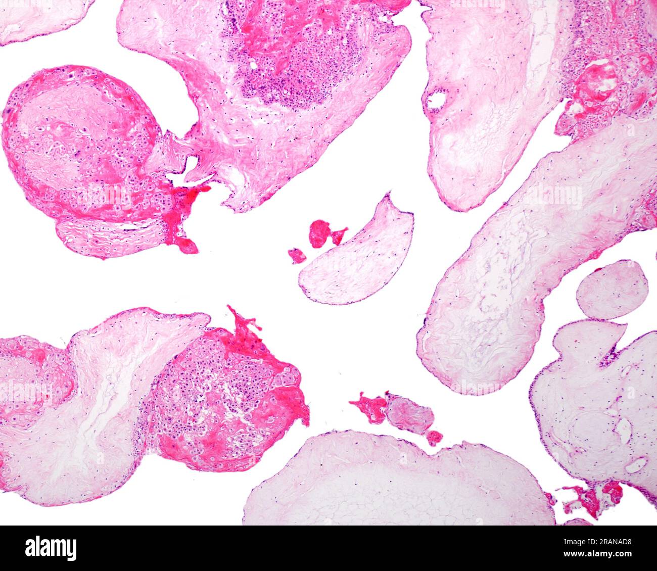 Hydatidiform mole, light micrograph Stock Photo - Alamy