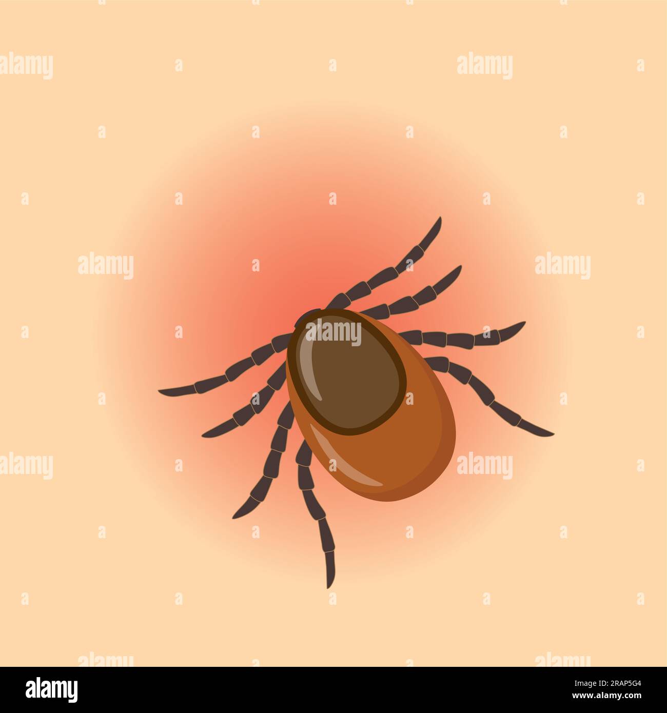 tick sticking in human skin, risk of infection of lyme and tick-borne disease -vector ...