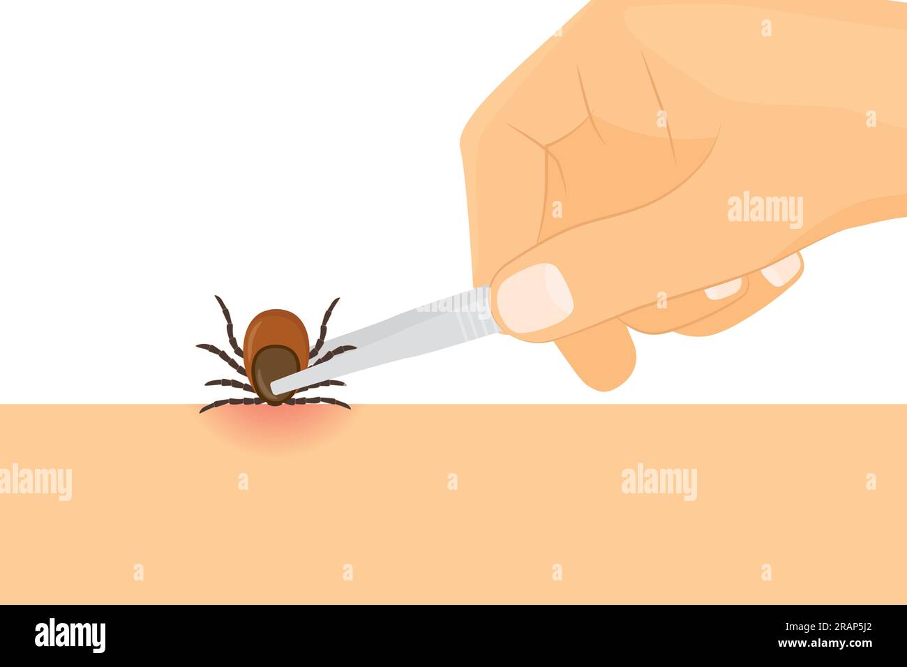 removing tick using tweezers, risk of infection of lyme and tick-borne disease- vector ...