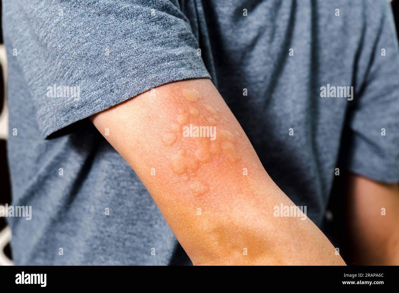 Red rash on skin hi-res stock photography and images - Alamy