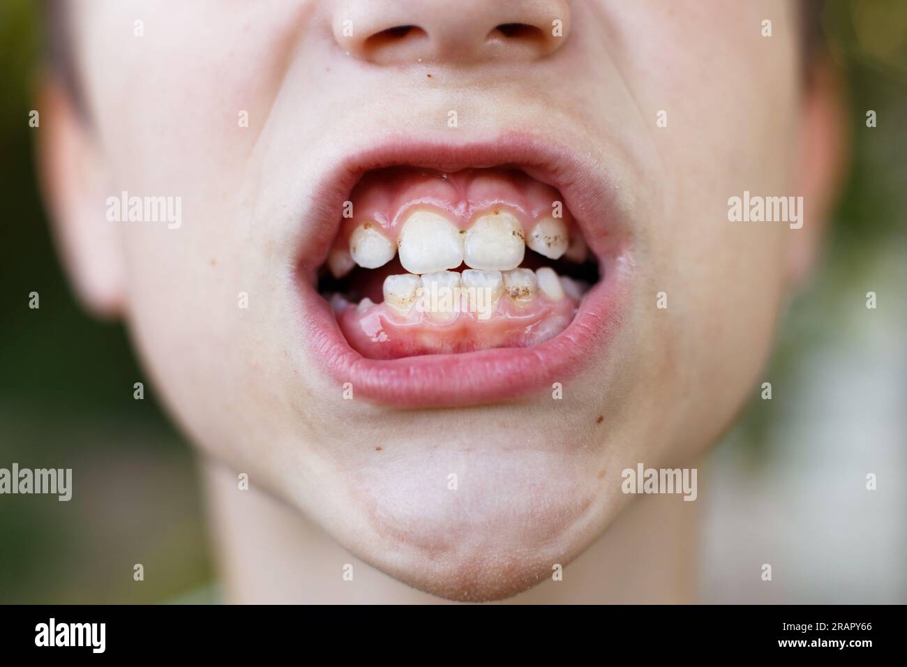 open mouth of a child boy with plaque or calculus on the teeth close ...