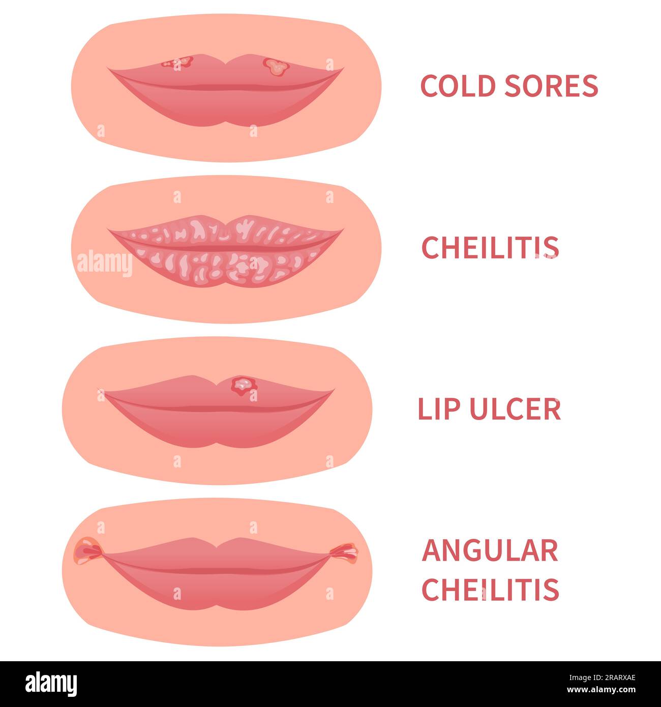 Gulf View Medical Centre Angular Cheilitis Also Known As 54 Off
