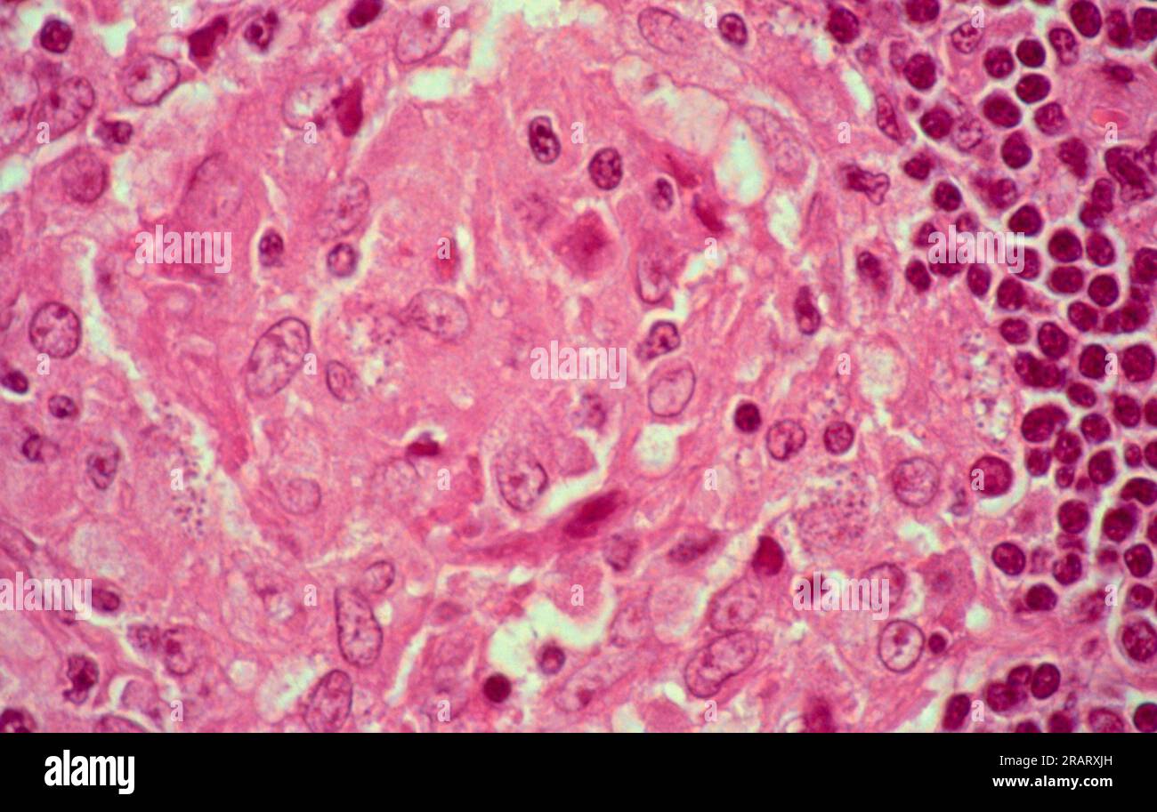 Visceral leishmaniasis hi-res stock photography and images - Alamy