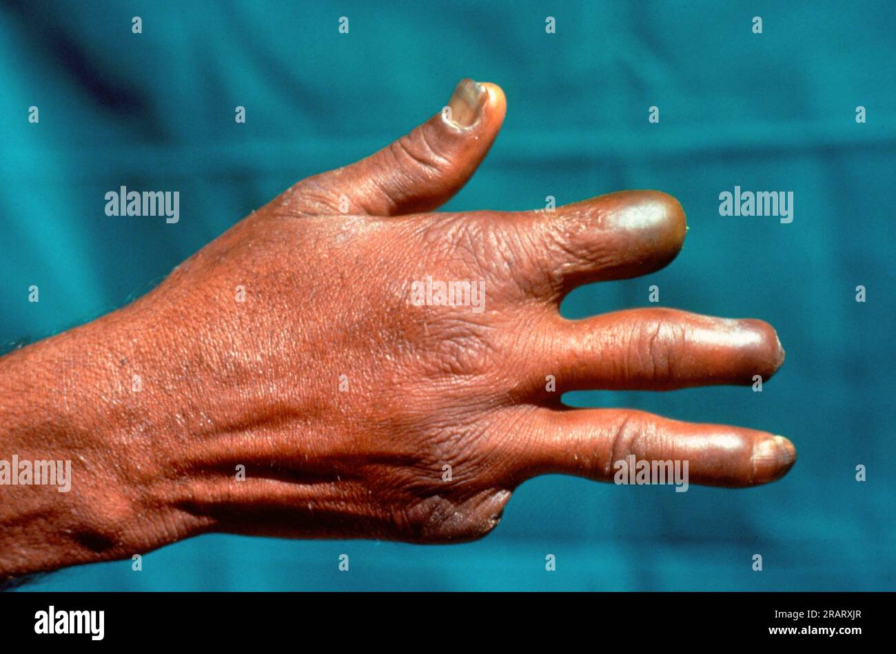 Vascular disease. - Description This patient has visible impairment of ...