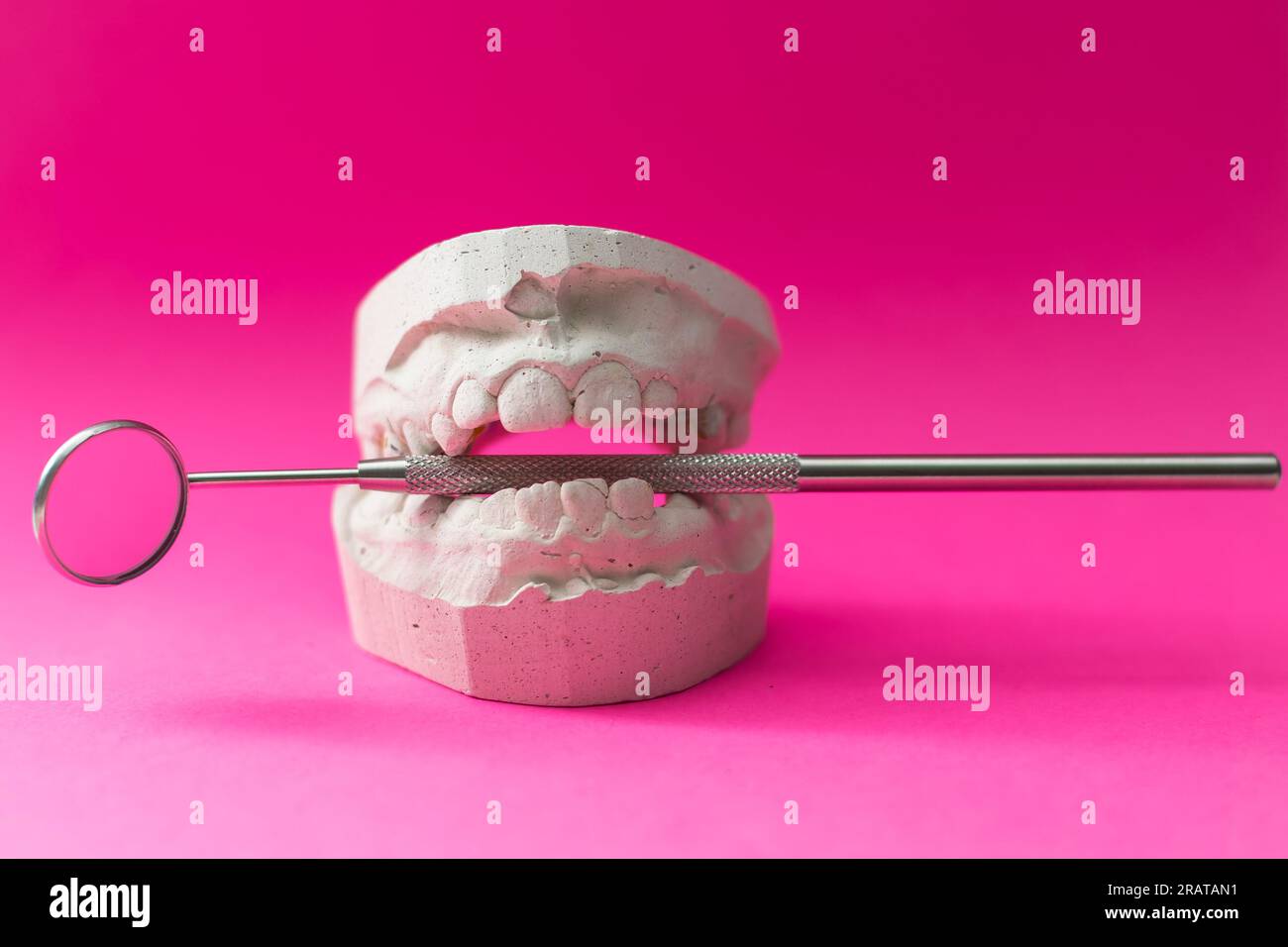 Dental casting gypsum model of human jaws. Crooked teeth and distal ...