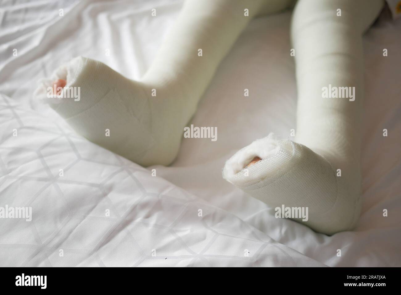 little child with plaster bandage on leg Stock Photo - Alamy