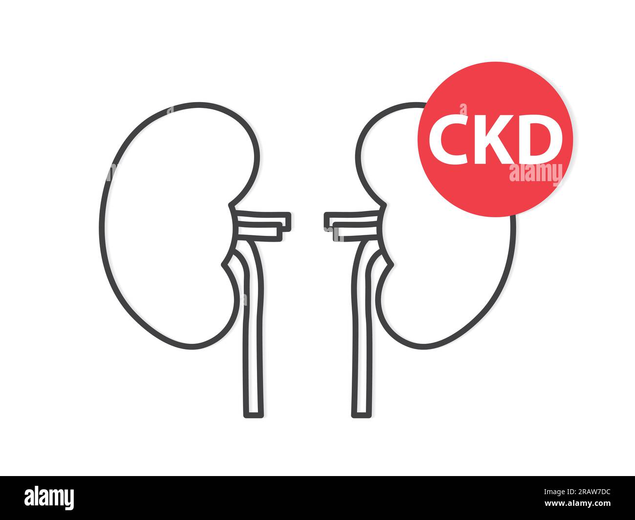 CKD (Chronic Kidney Disease) acronym and kindey outline- vector ...