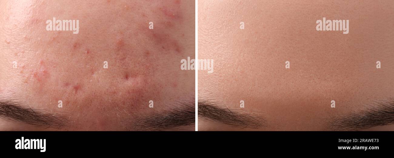 Collage with photos of woman with acne problem before and after ...