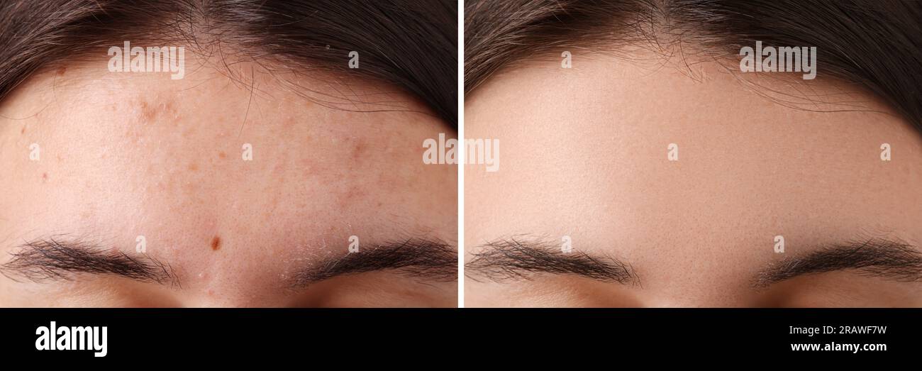 Collage with photos of woman with acne problem before and after ...