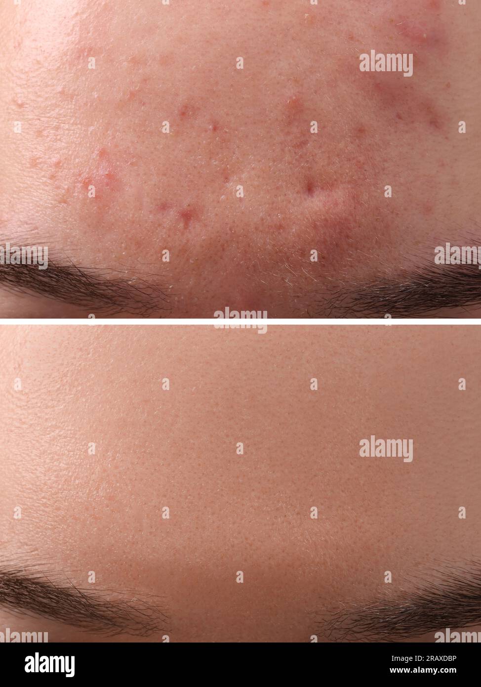Collage with photos of woman with acne problem before and after ...