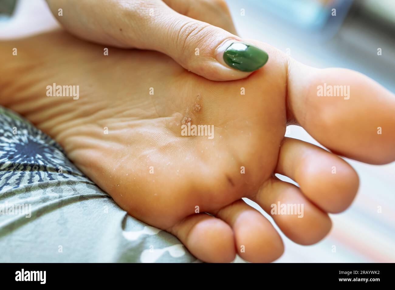 verruca benign neoplasm in adolescence Stock Photo - Alamy