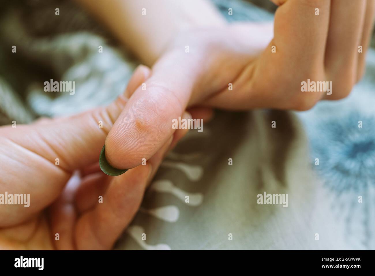 verruca benign neoplasm in adolescence Stock Photo - Alamy