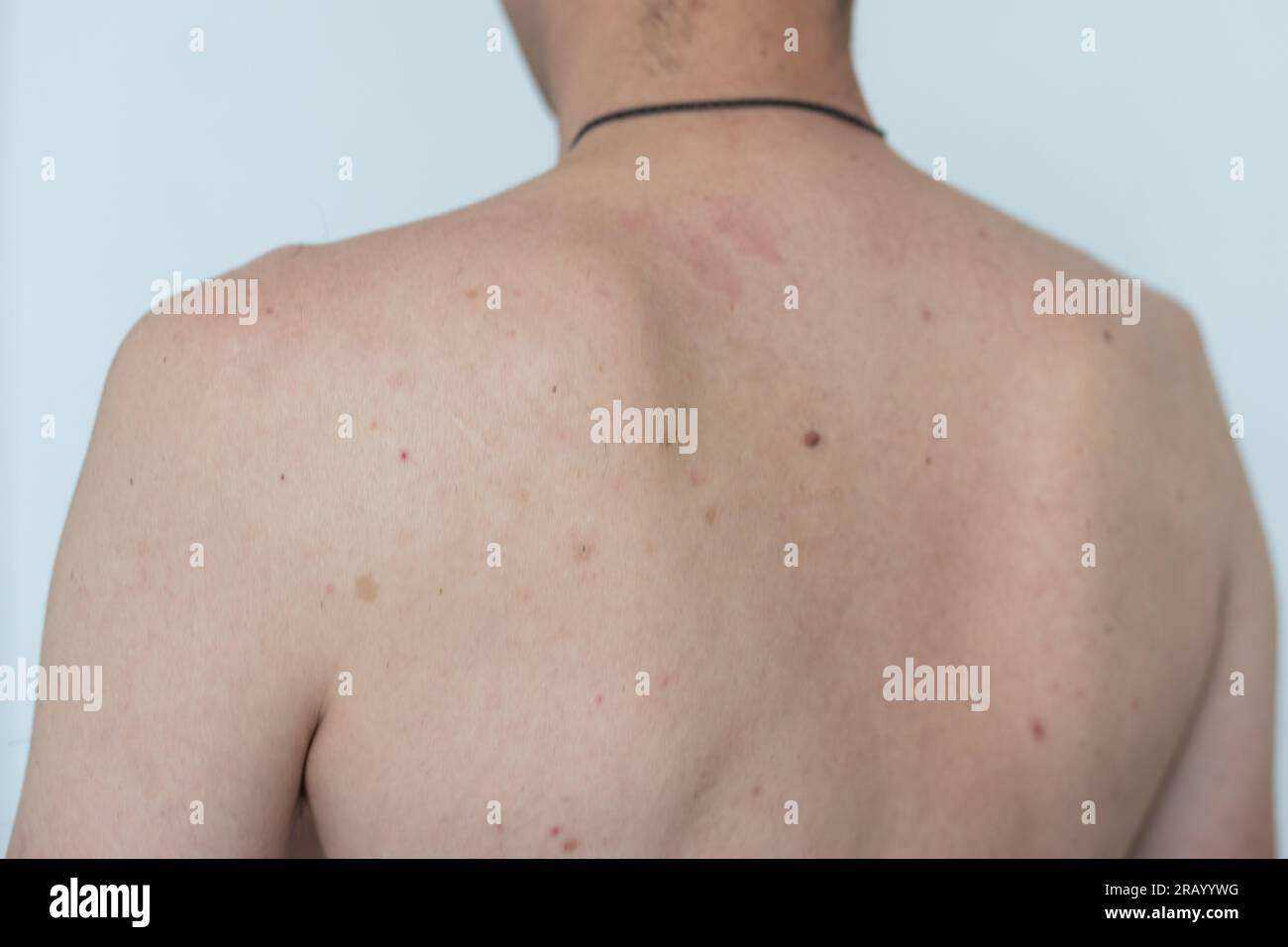 Male body with vitiligo. White spots on the skin. Vitiligo Stock Photo ...