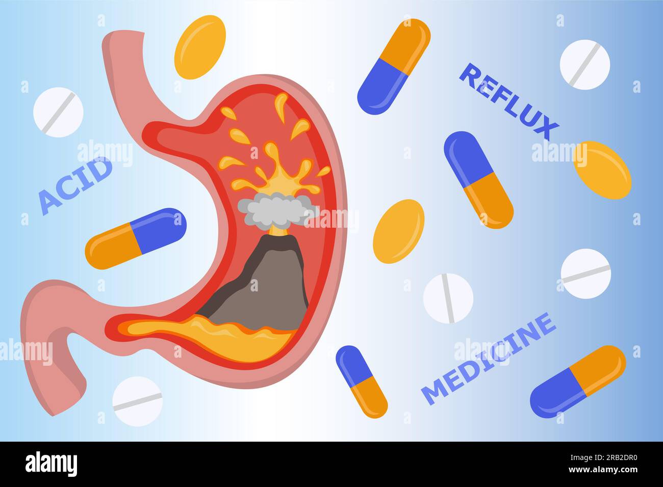 Heartburn treatment. Stomach illustration and antacid pills falling on ...