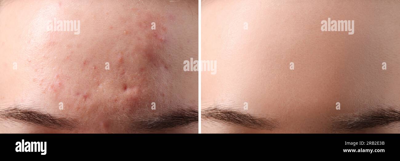 Collage with photos of woman with acne problem before and after ...