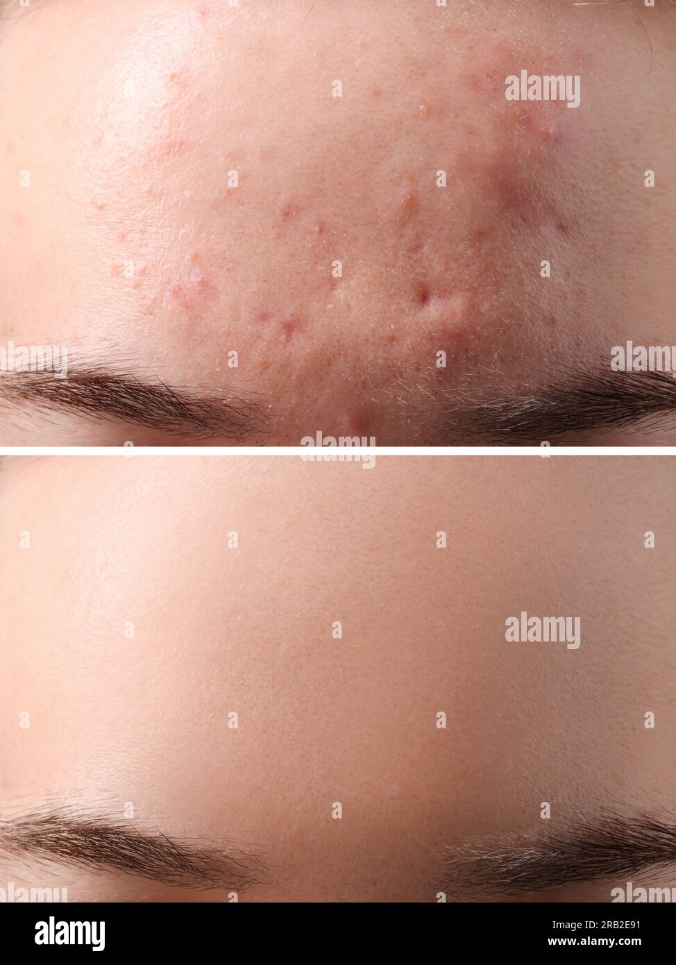 Collage with photos of woman with acne problem before and after ...