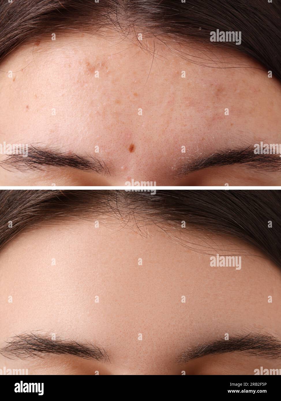 Collage with photos of woman with acne problem before and after ...