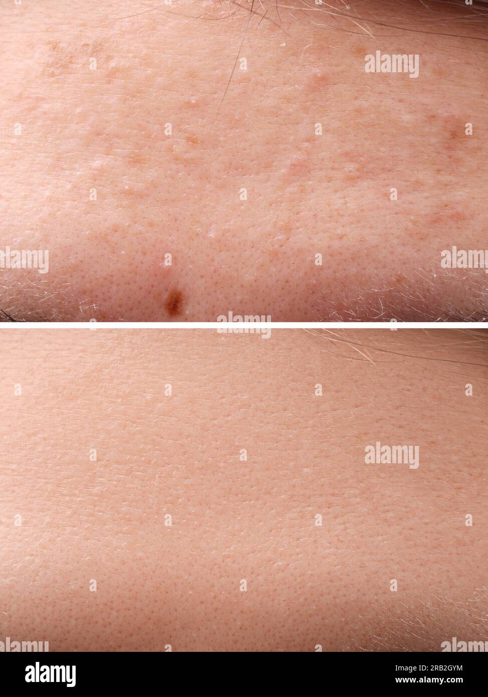 Collage with photos of woman with acne problem before and after ...
