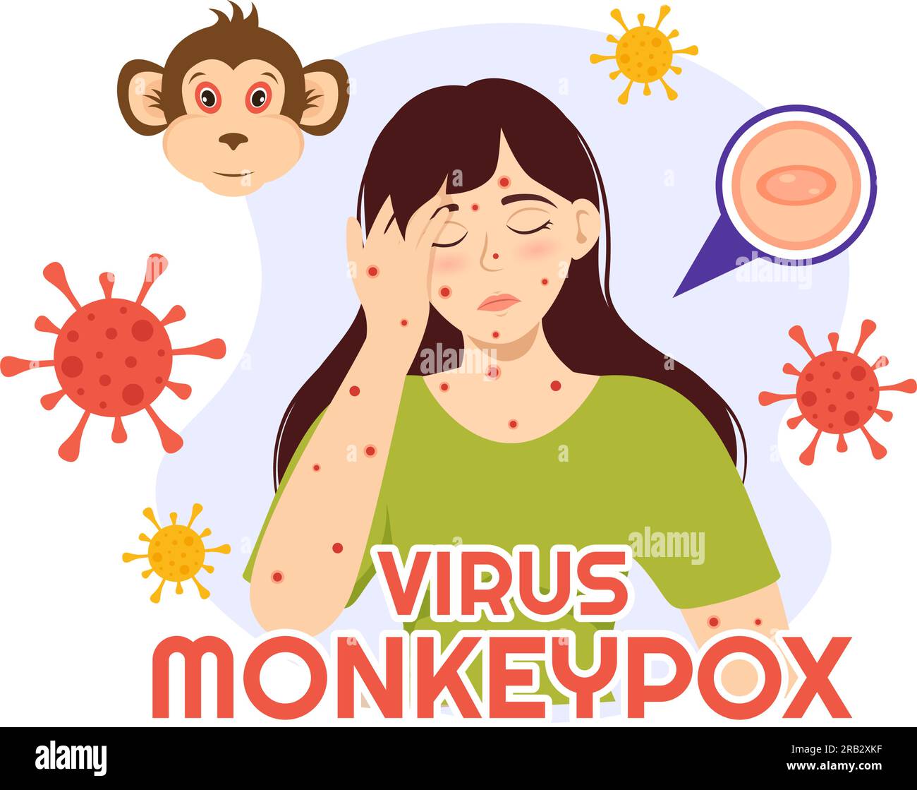 Monkey Pox Outbreak Vector Illustration of Virus Symptoms in Humans ...