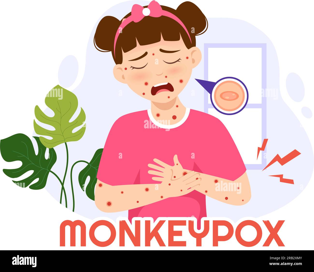 Monkey Pox Outbreak Vector Illustration of Virus Symptoms in Humans ...