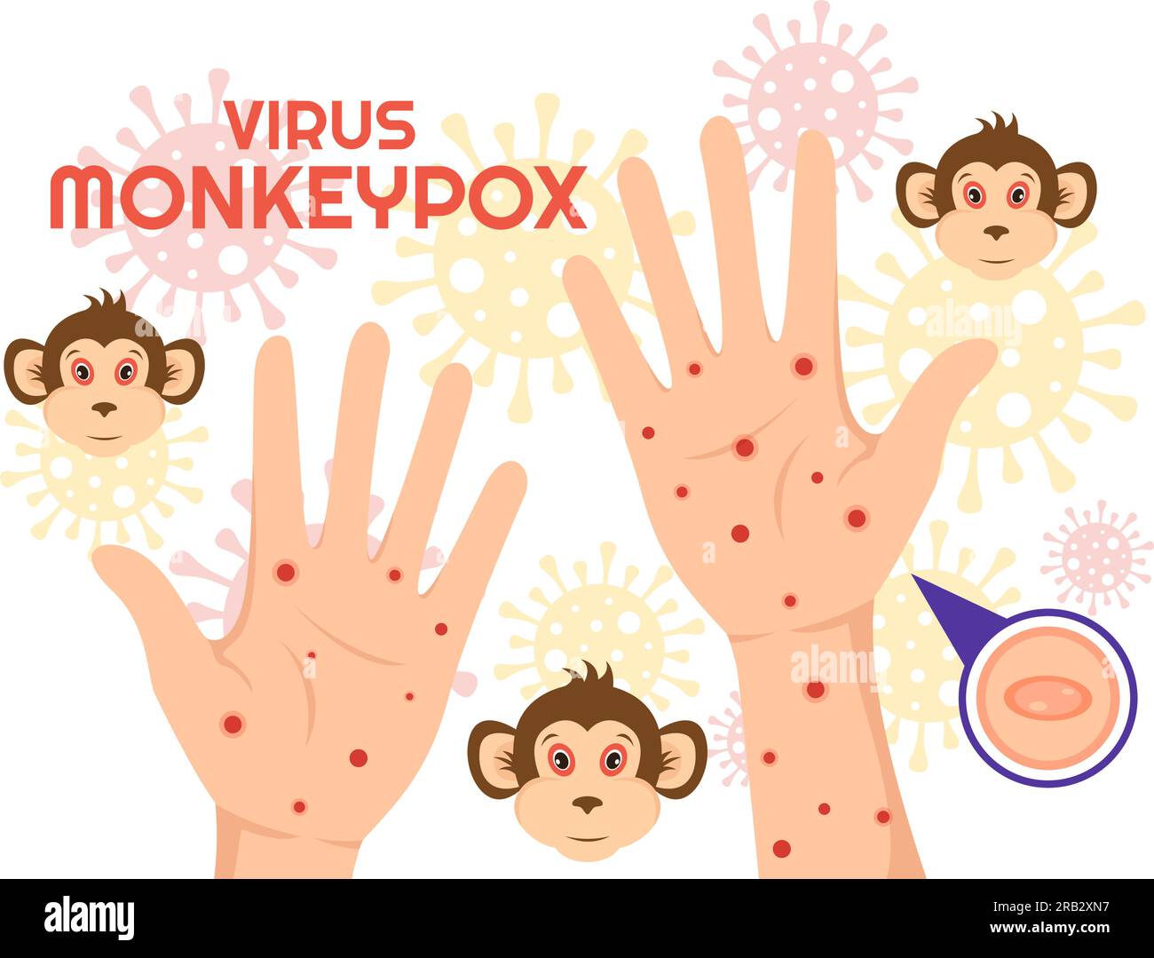 Monkey Pox Outbreak Vector Illustration of Virus Symptoms in Humans ...